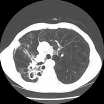 Think Nontuberculous Mycobacterial (NTM) Lung Disease | NTMFacts