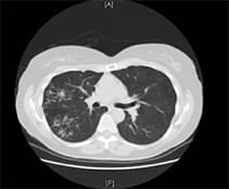 Think Nontuberculous Mycobacterial (NTM) Lung Disease | NTMFacts
